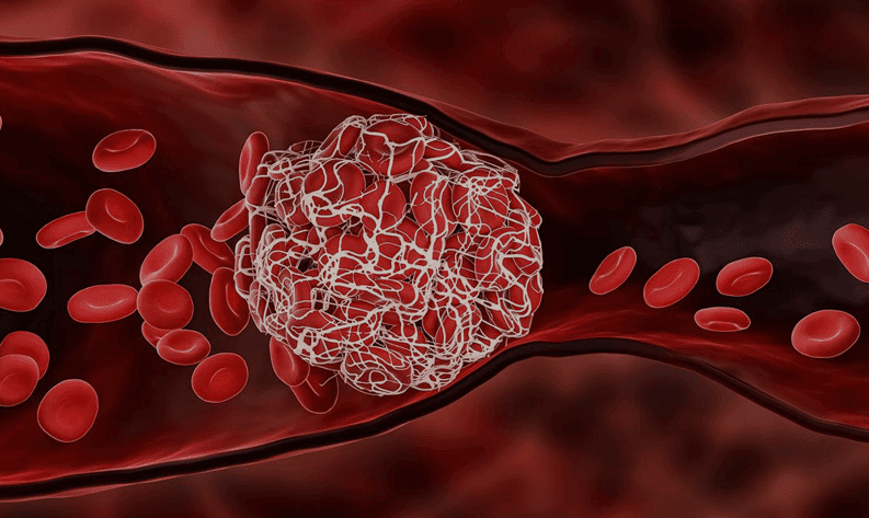 eKorinthos • Τι είναι η θρομβοφιλία;